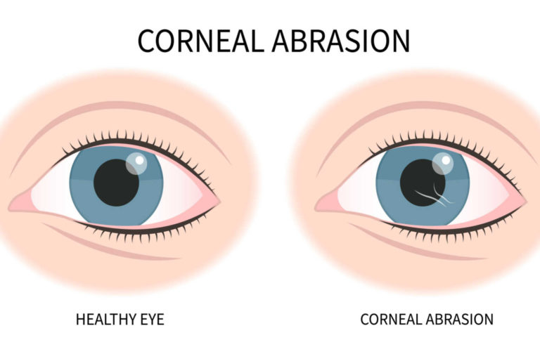 What Is Corneal Abrasion and How Can It Be Treated?