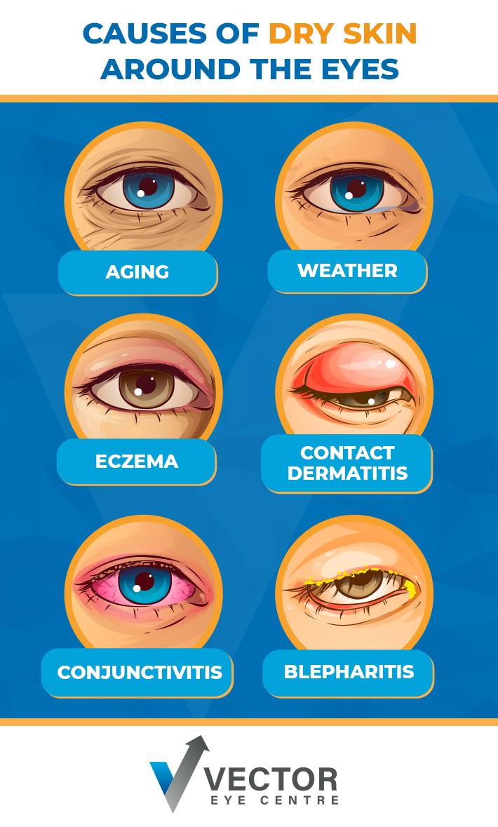What Causes Dry Skin Around The Eyes Calgary