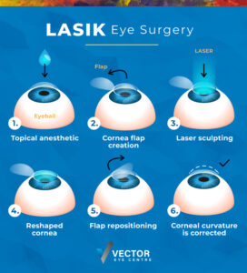 How Long Does LASIK Take? | Vector Eye Centre